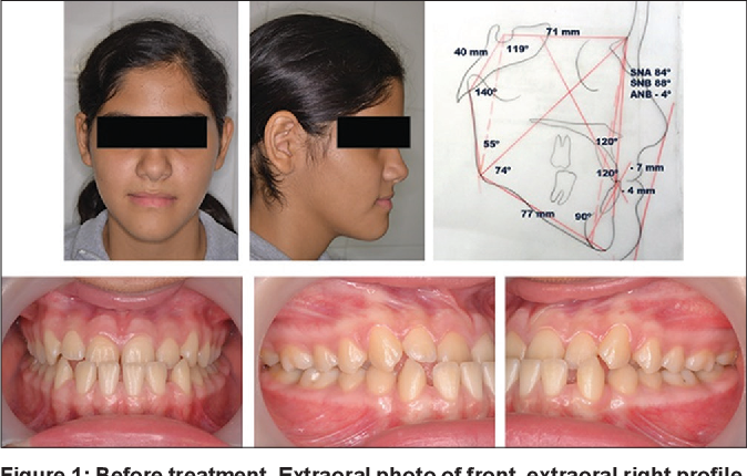 Figure 1 From Orthodontic Camouflage A Treatment Option A Clinical