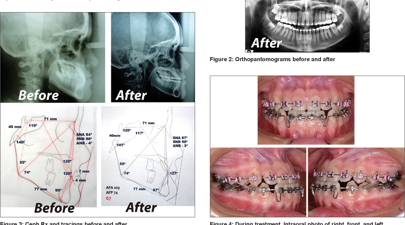 Figure 2 From Orthodontic Camouflage A Treatment Option A Clinical