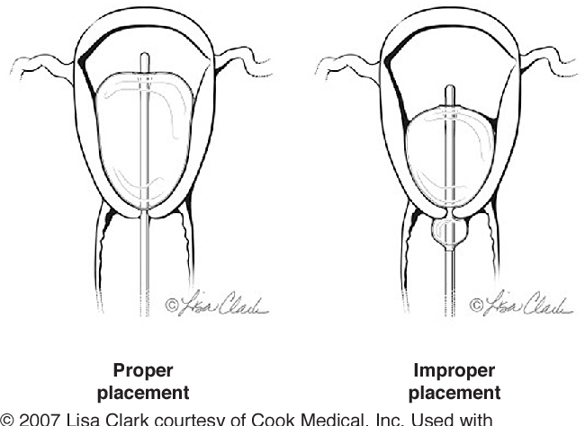 Vaginal Bleeding In The Nonpregnant Patient Hot Sex Picture