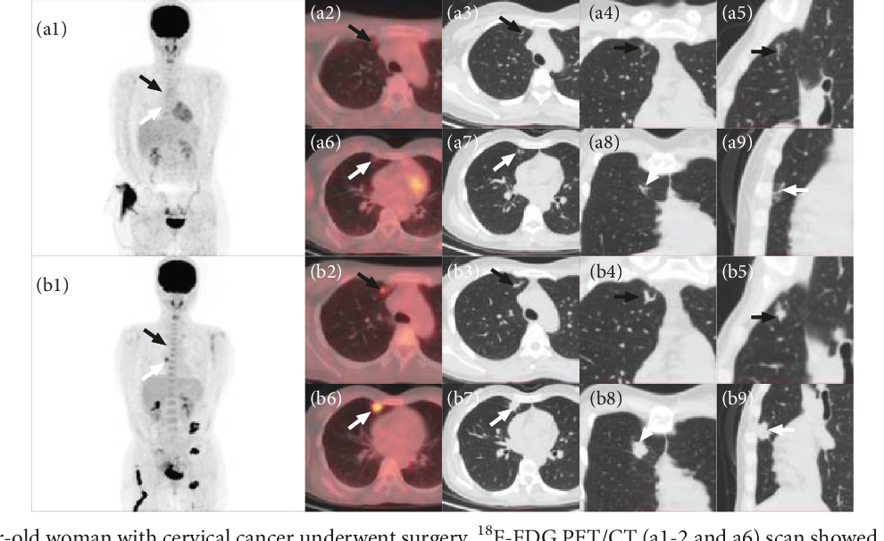 Figure 1 From Value Of 18f Fdg Petct Combined With Lung Hrct In