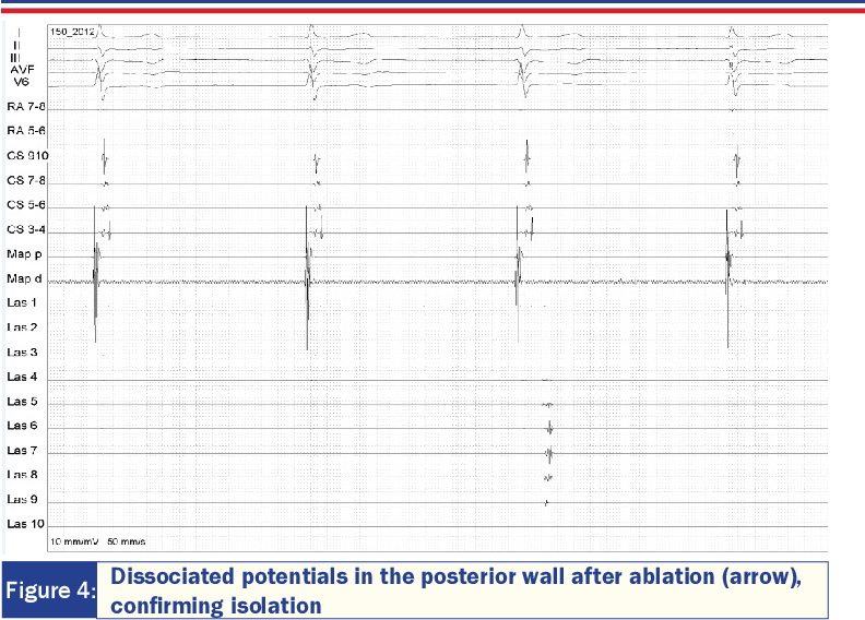 Figure 1 From Complete Isolation Of The Left Atrial Posterior Wall Box