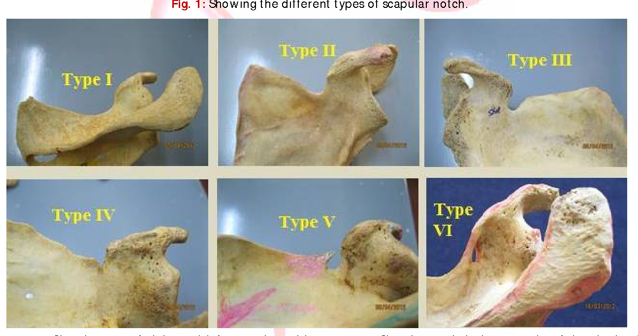 Figure 1 From Morphology Of Suprascapular Notch A Study On 176 Dry