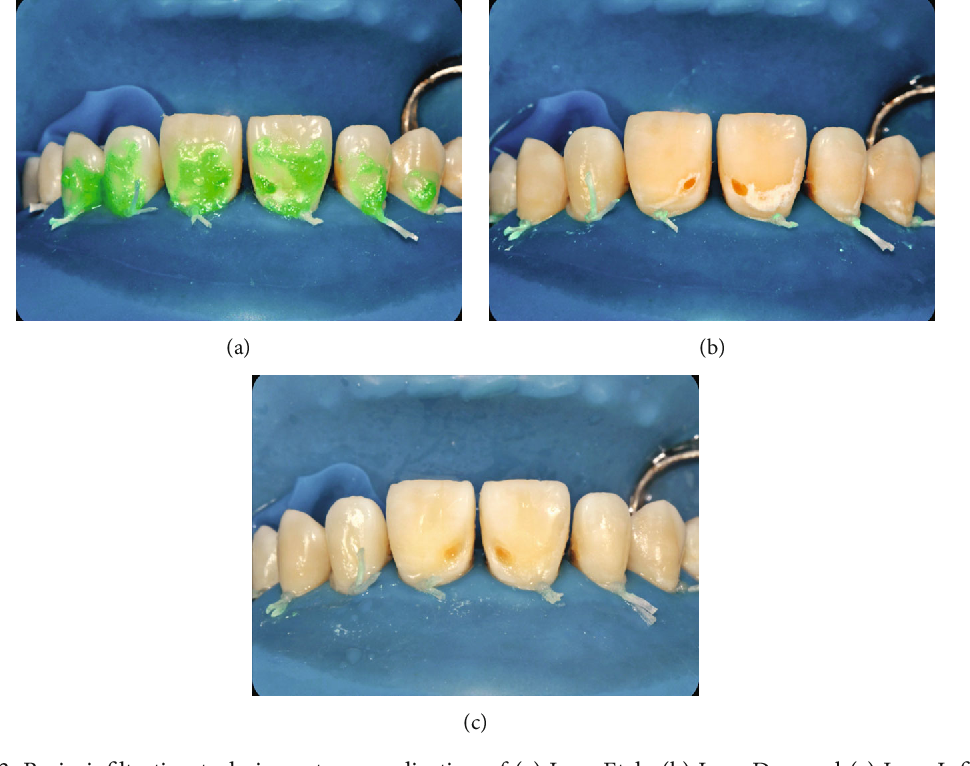 Figure 3 From Using Resin Infiltration Technique And Direct Composite