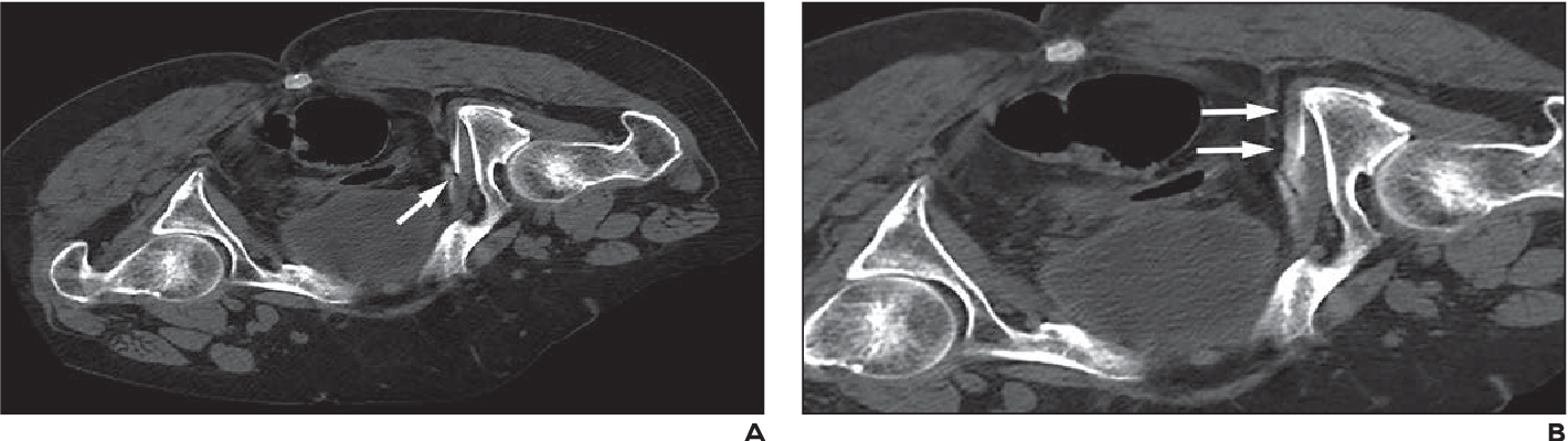 Ct Guided Nerve Block For Pudendal Neuralgia Diagnostic And