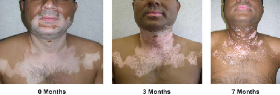 Phototherapy For Vitiligo