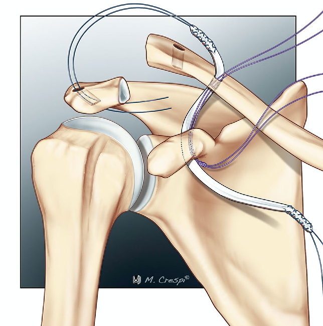 Coracoclavicular Ligament Semantic Scholar