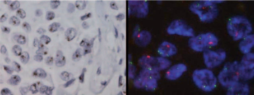 Figure 1 From Chromogenic In Situ Hybridisation Testing For Her2 Gene