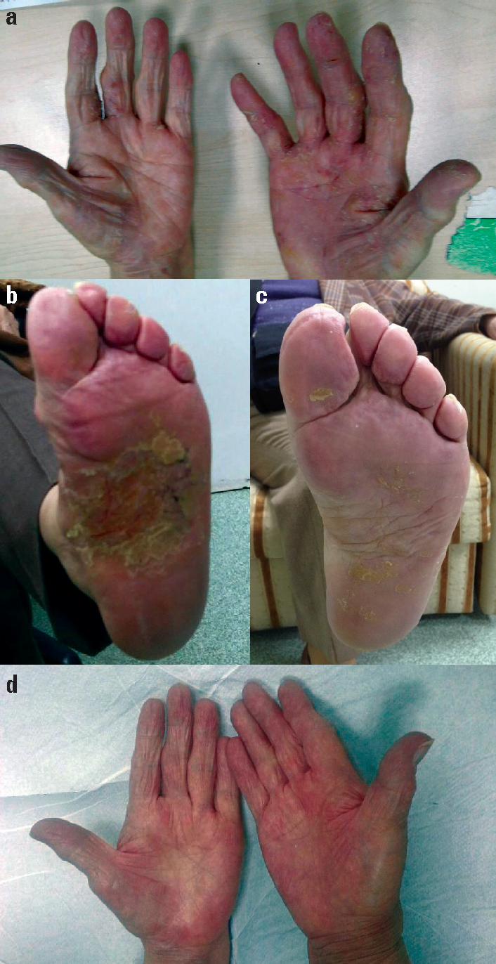 Pdf A Rare Side Effect Seen Due To The Use Of Apixaban Palmoplantar