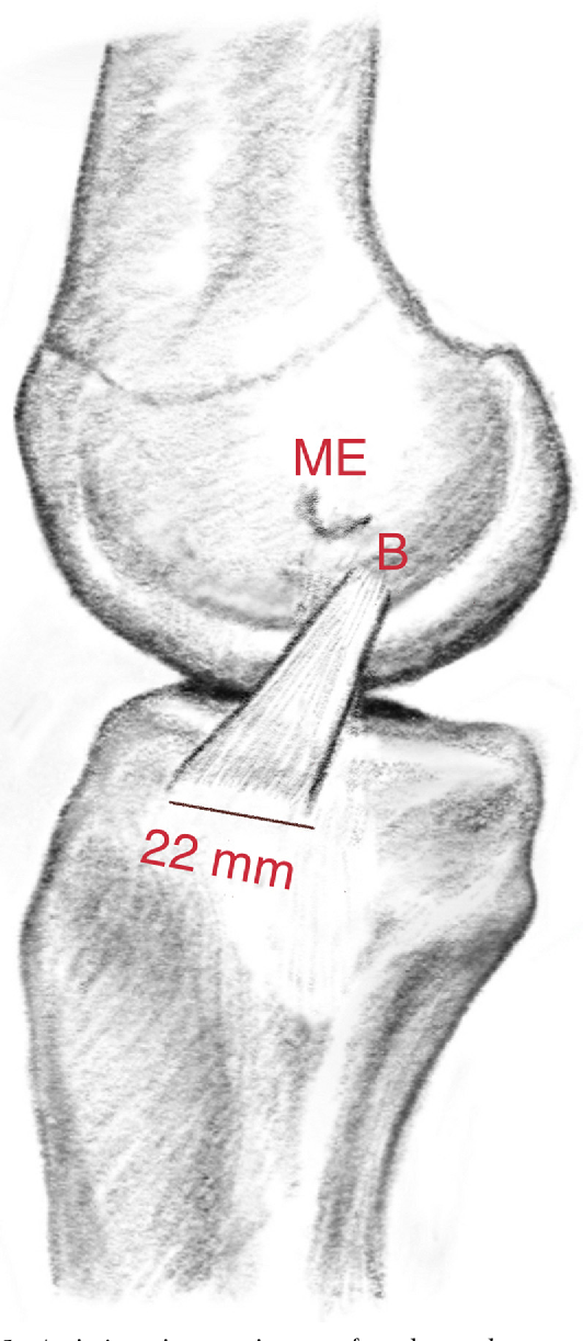 The “figure Of Four” Reconstruction Of The Medial Collateral Ligaments