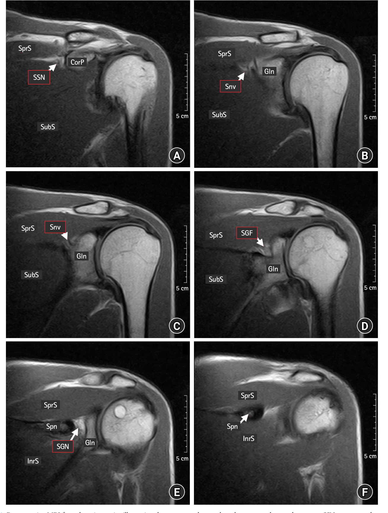 Figure 1 From Suprascapular Notch Cross Sectional Area On Mri Is Not