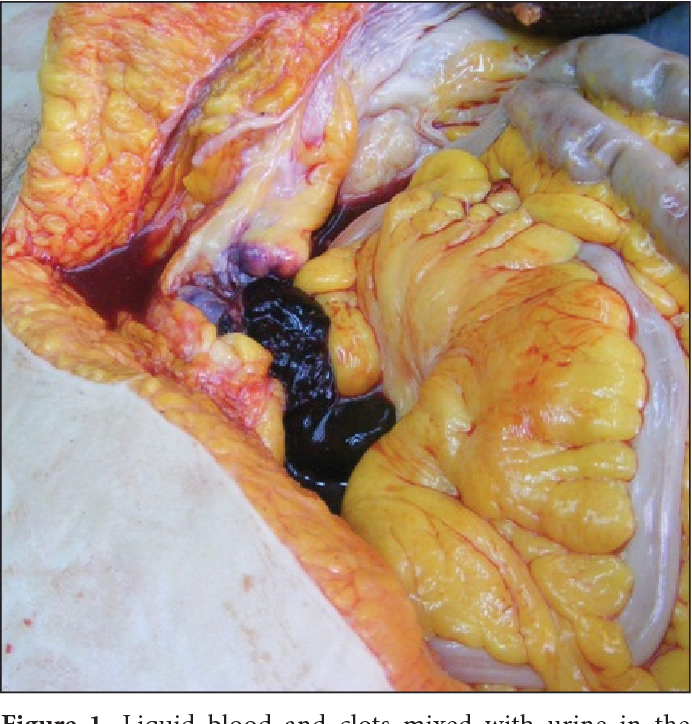 Figure 1 From Idiopathic Spontaneous Rupture Of The Urinary Bladder A