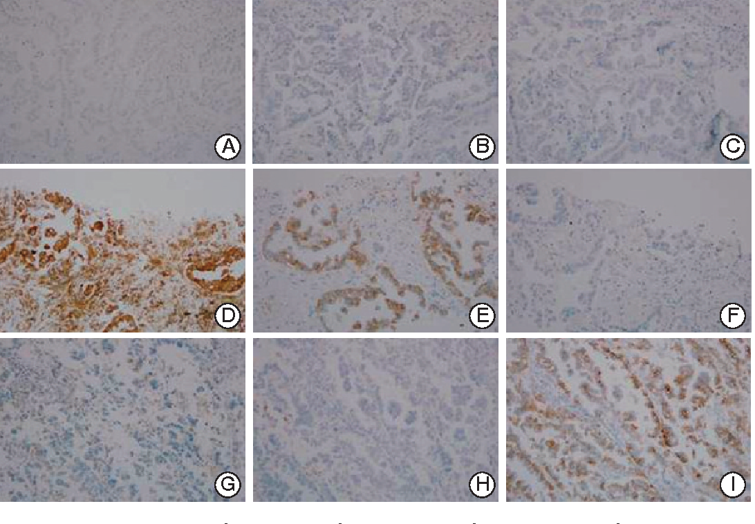 Figure 1 From Identification Of Egfr Mutations By Immunohistochemistry