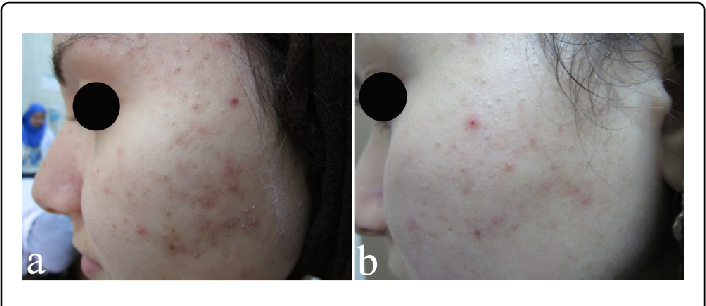 Figure 1 From A Study Of The Efficacy Of 5 Dapsone Gel As A Topical