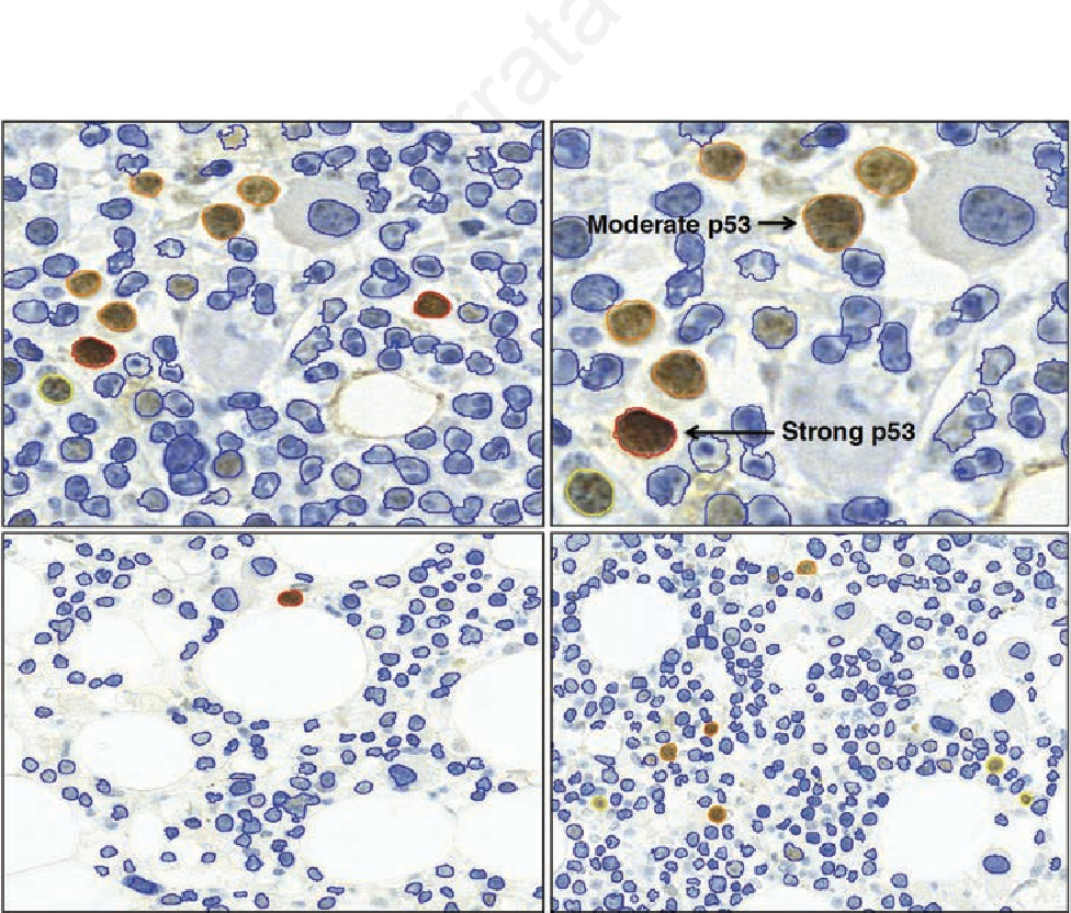 Figure 1 From P53 Protein Expression Independently Predicts Outcome In