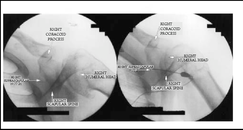 Figure 1 From Pulsed Mode Radiofrequency Lesioning Of The Suprascapular