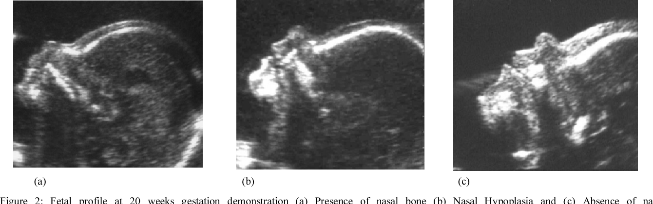 Nasal Bone Ultrasound