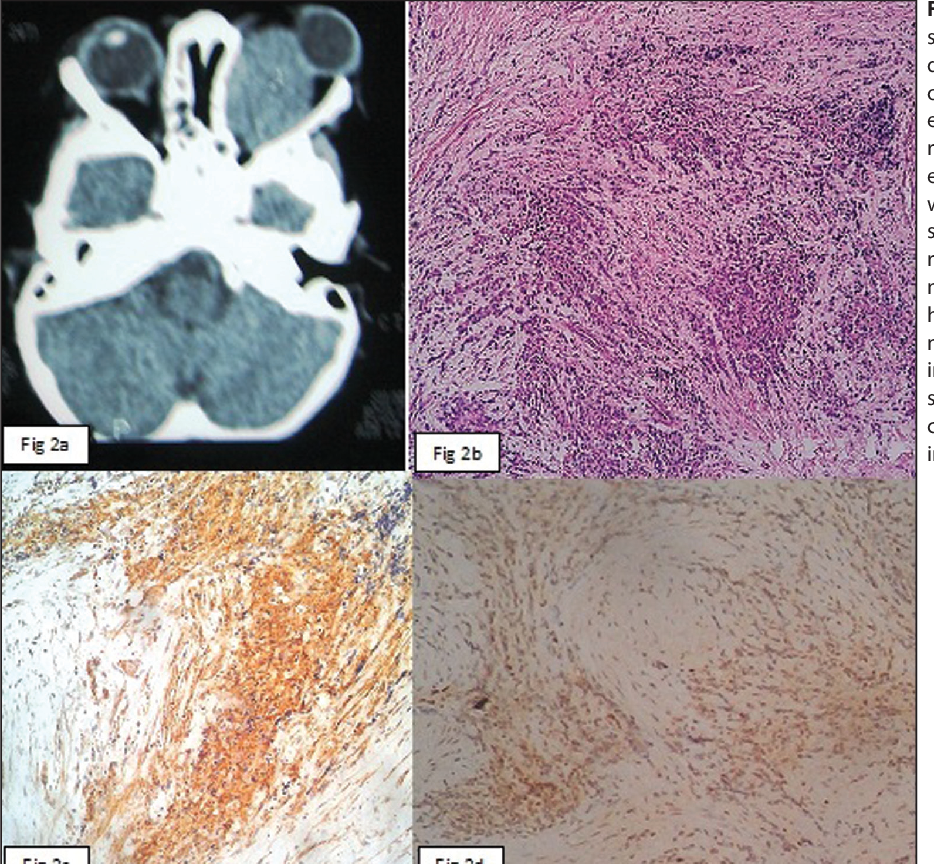 Figure 1 From Pediatric Orbital Primitive Neuroectodermal Tumors