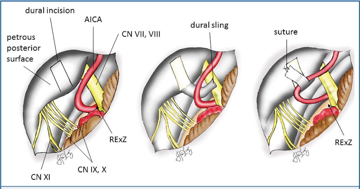 A “sling Swing Transposition” Technique With Pedicled Dural Flap For