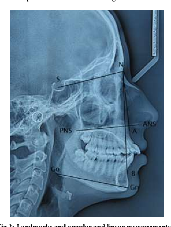 Relationship Between Frontal Sinus Width And Skeletal Jaw Pattern A