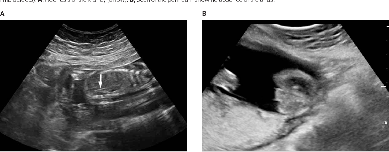 Pdf Sonographic Depiction Of The Fetal Anus And Its Utility In The