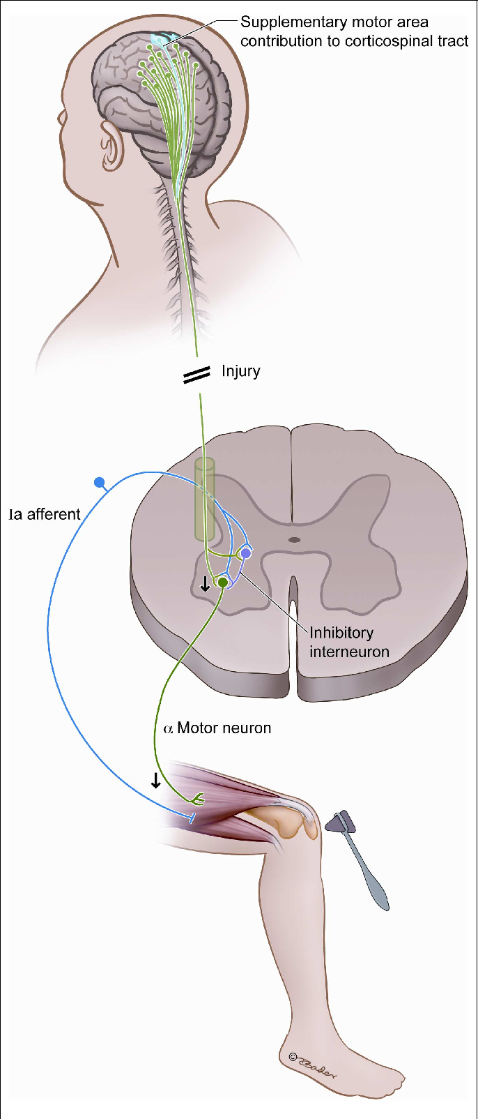 Figure 1 From Lower Motor Neuron Findings After Upper Motor Neuron