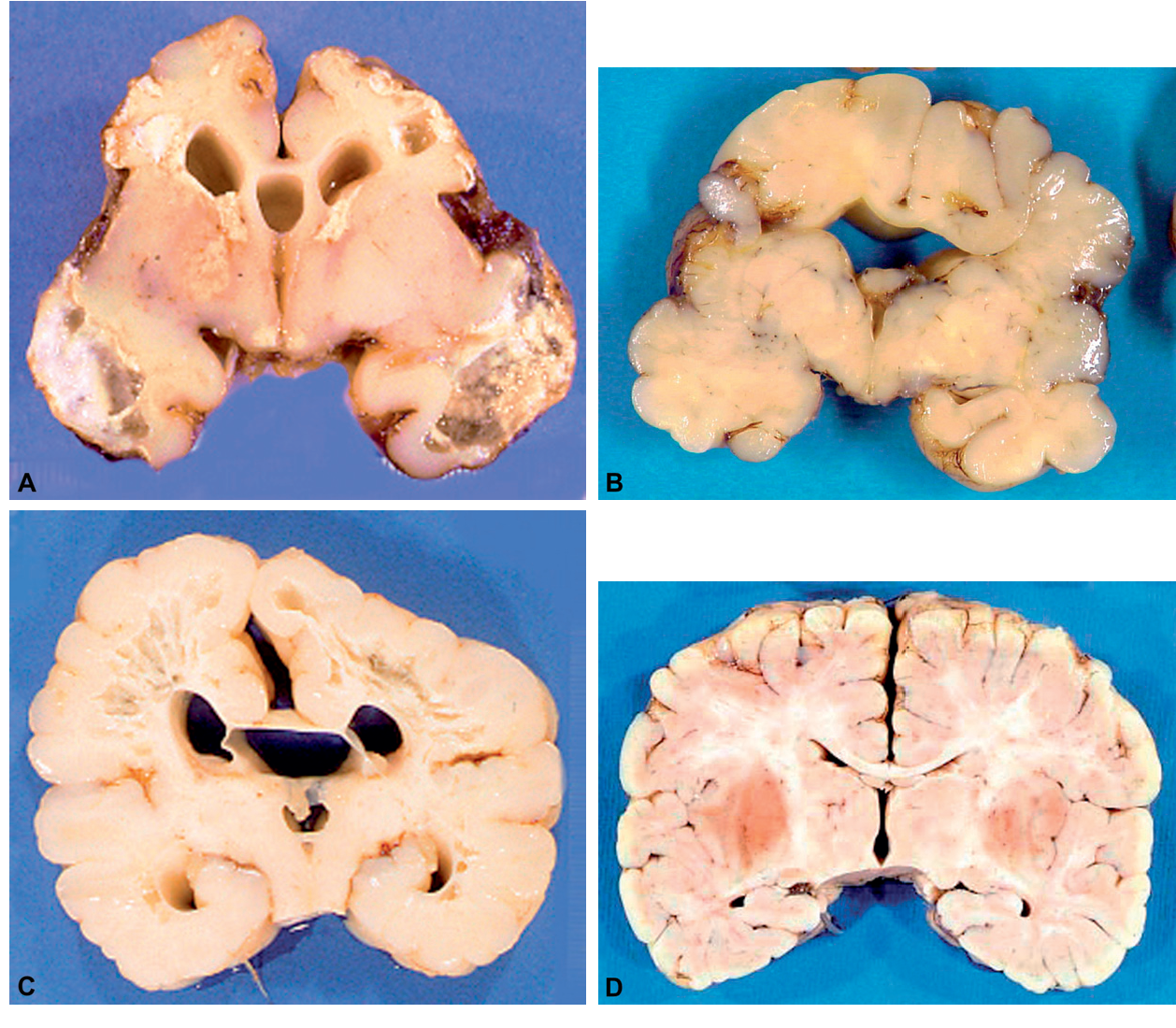 Figure 162 From Pathophysiology Of Cerebral Palsy Semantic Scholar