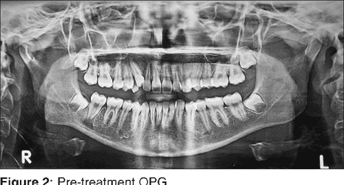 Pdf Primary Tuberculous Osteomyelitis Of The Mandible A Rare Case