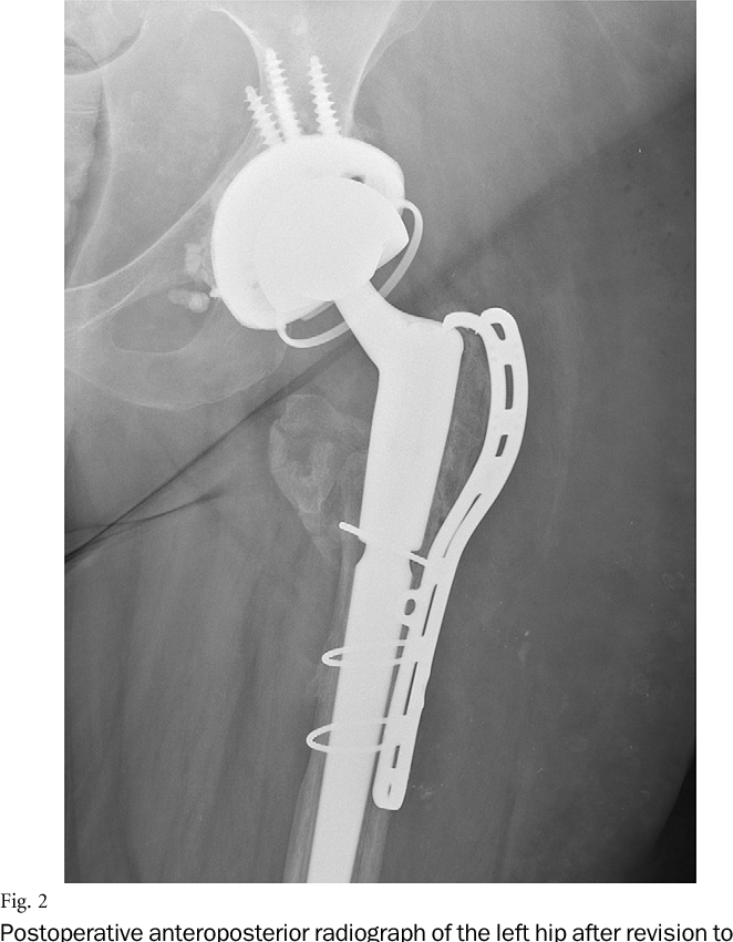 Figure 1 From Intraprosthetic Dislocation Of Dual Mobility Bearings