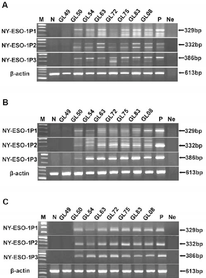 Figure 1 From Comparisons For Detecting Ny Eso 1 Mrna Expression Levels