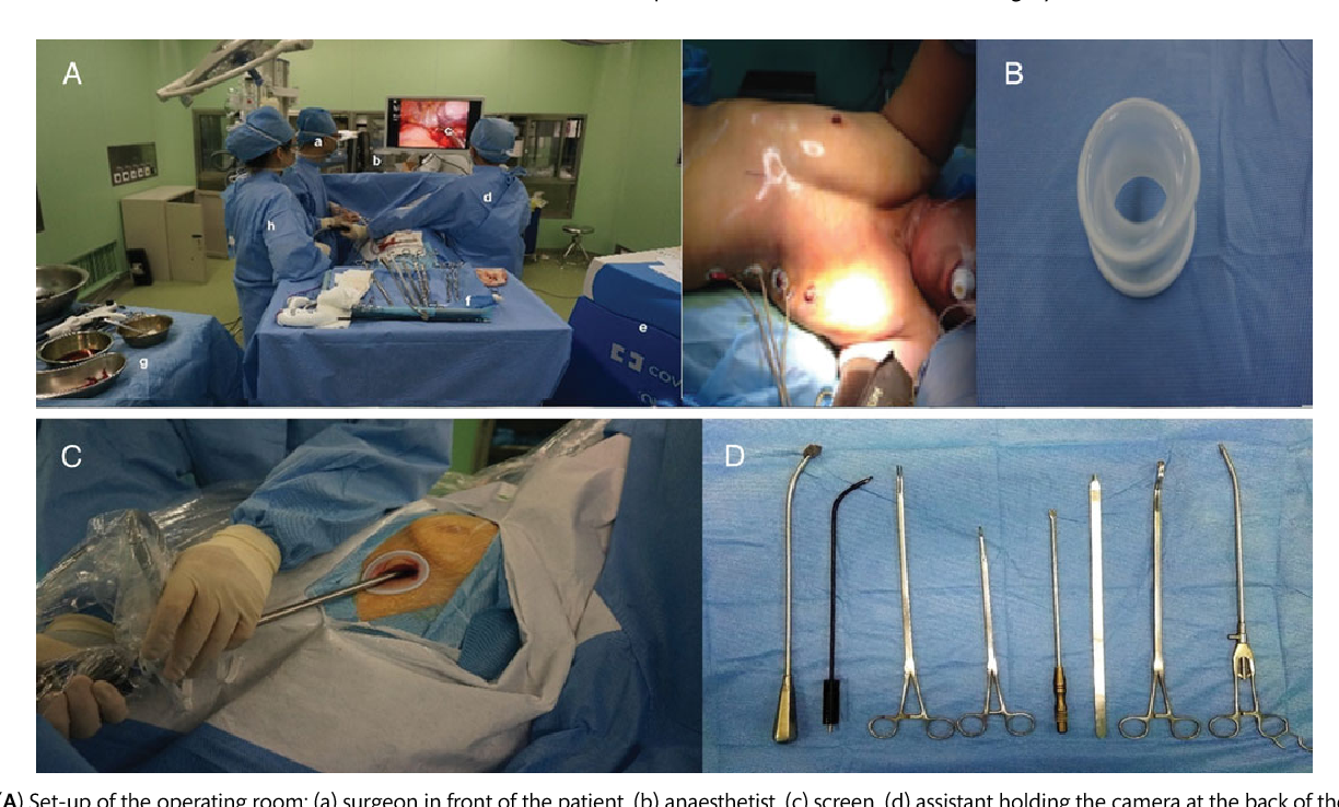 Figure 1 From Initial Experience In Uniportal Subxiphoid Video Assisted