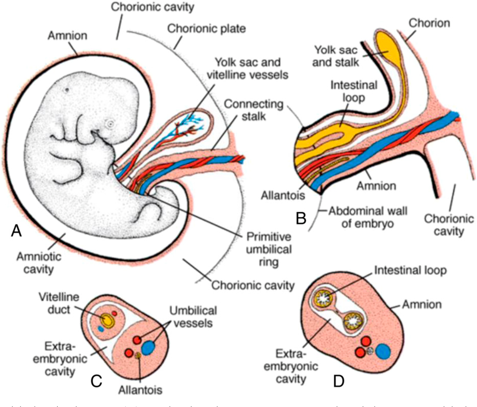 Figure 4 From Disorders Of The Umbilical Cord Semantic Scholar