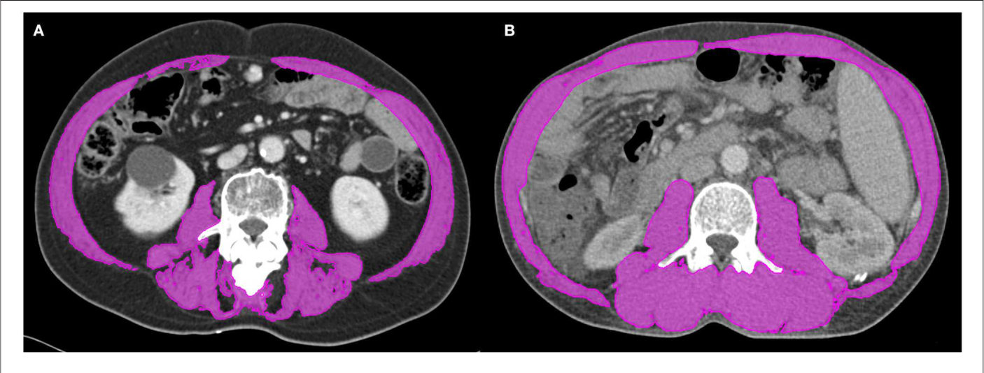 Figure 1 From Skeletal Muscle Depletion Predicts The Prognosis Of