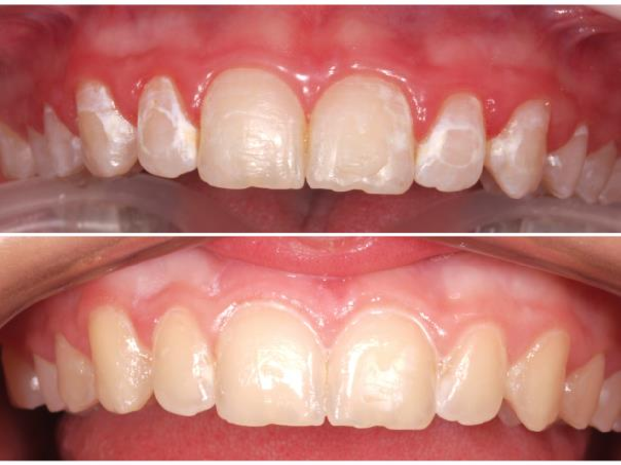 Resin Infiltration Of Enamel White Spot Lesions An