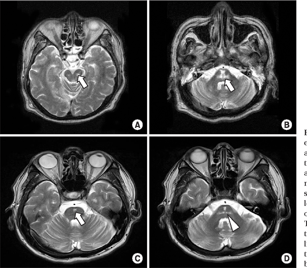 Figure 2 From Corticospinal Tract And Pontocerebellar Fiber Of Central