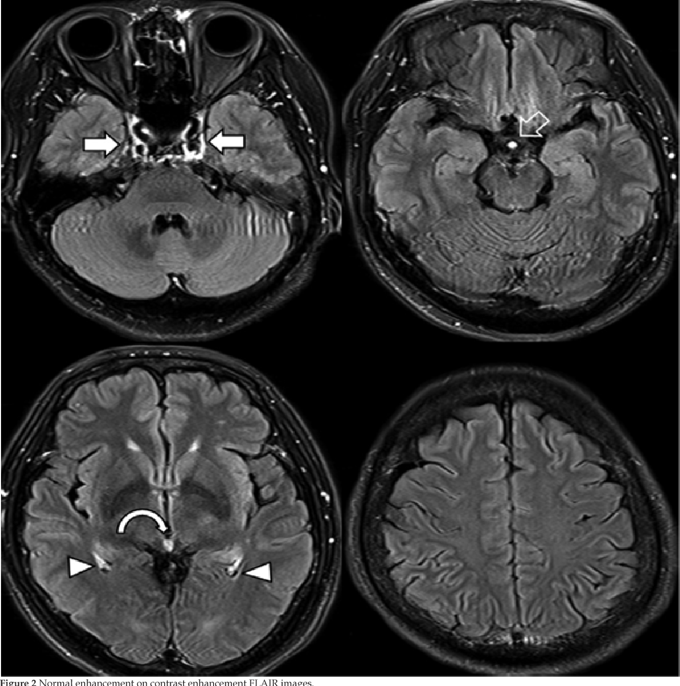 Comparison Of Gadolinium Based T1 Weighted And Flair Mr Sequences For