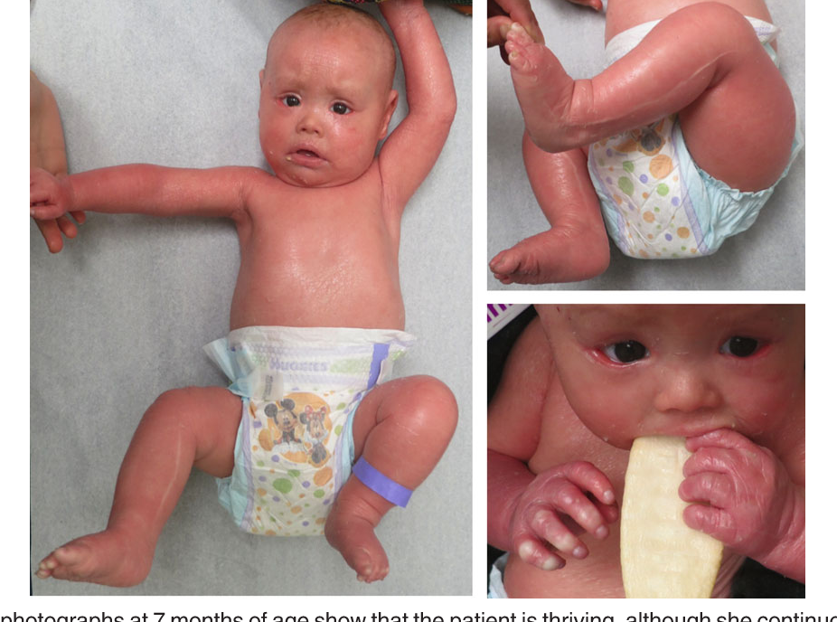 Figure 3 From Harlequin Ichthyosis A Surgical Perspective Semantic