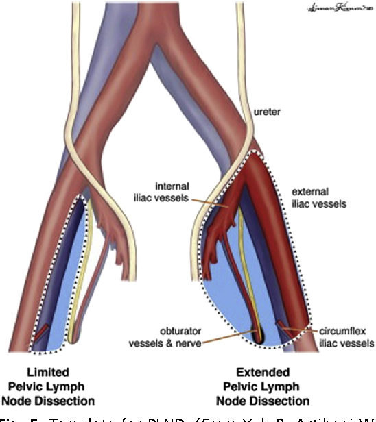 Figure 1 From Surgical Advances In Inguinal Lymph Node Dissection