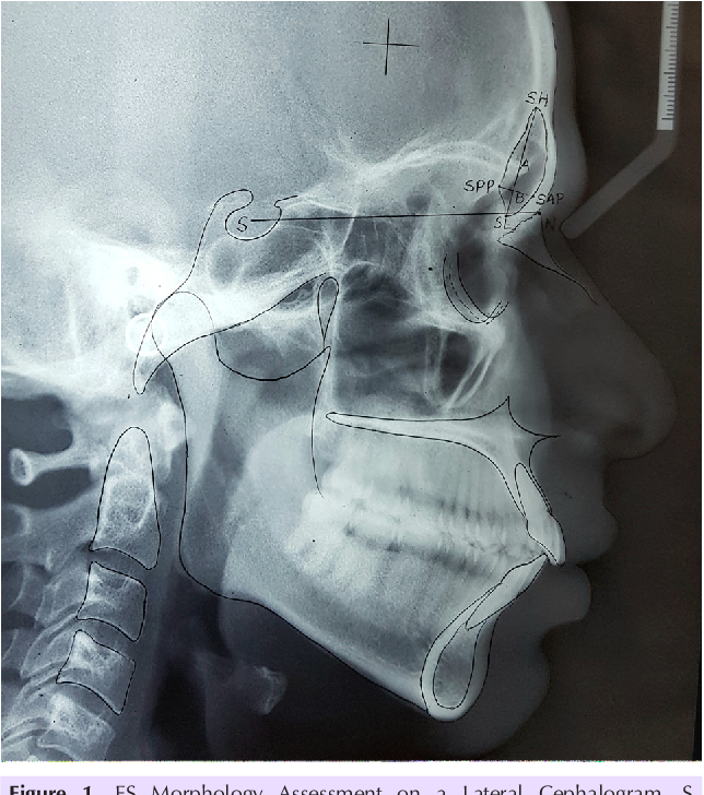 Figure 1 From Assessment Of Frontal Sinus Morphology And Cervical