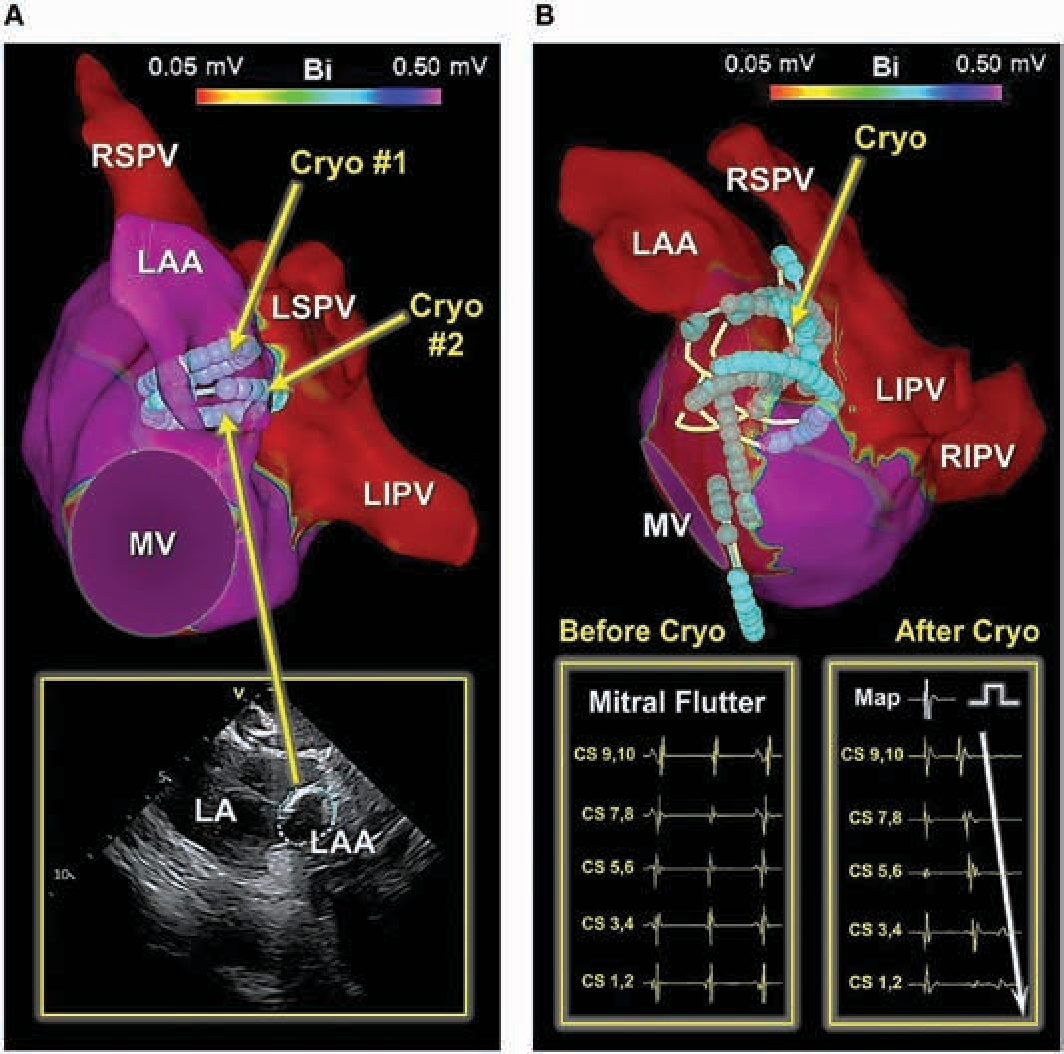 Figure 1 From Cryoballoon Ablation Of The Pulmonary Veins The