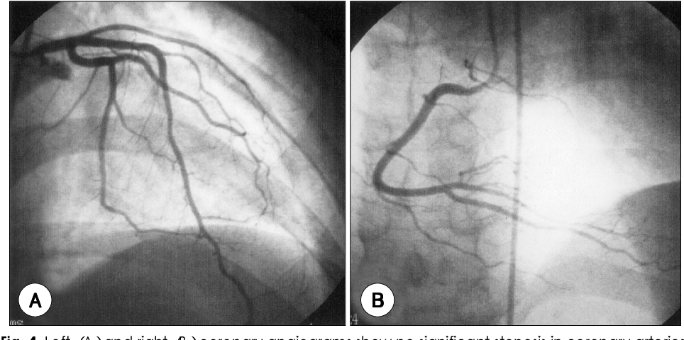 Figure 1 From A Case Of Hereditary Antithrombin Iii Deficiency