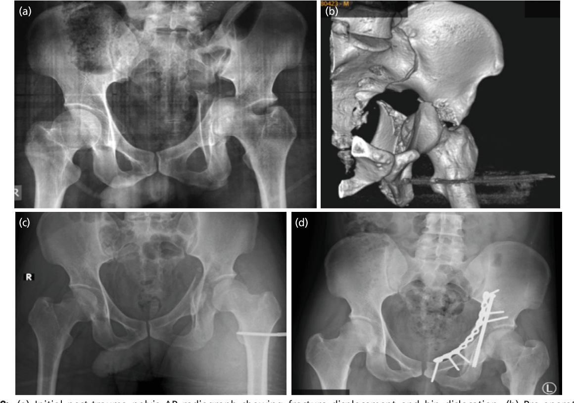 Pdf Reduction Of Displaced Acetabular Fracture With Central Hip