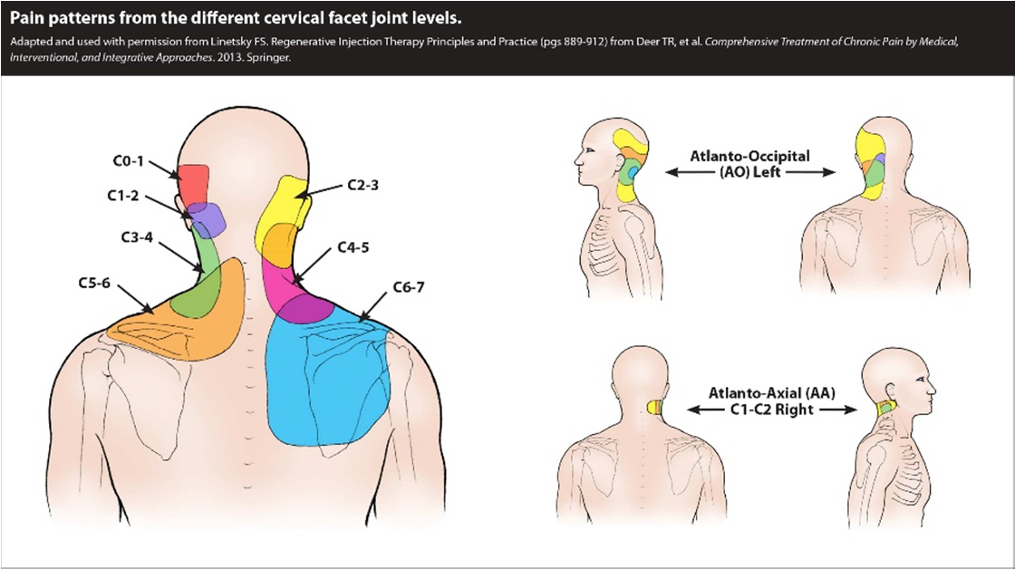 Figure 5 From The Biology Of Prolotherapy And Its Application In