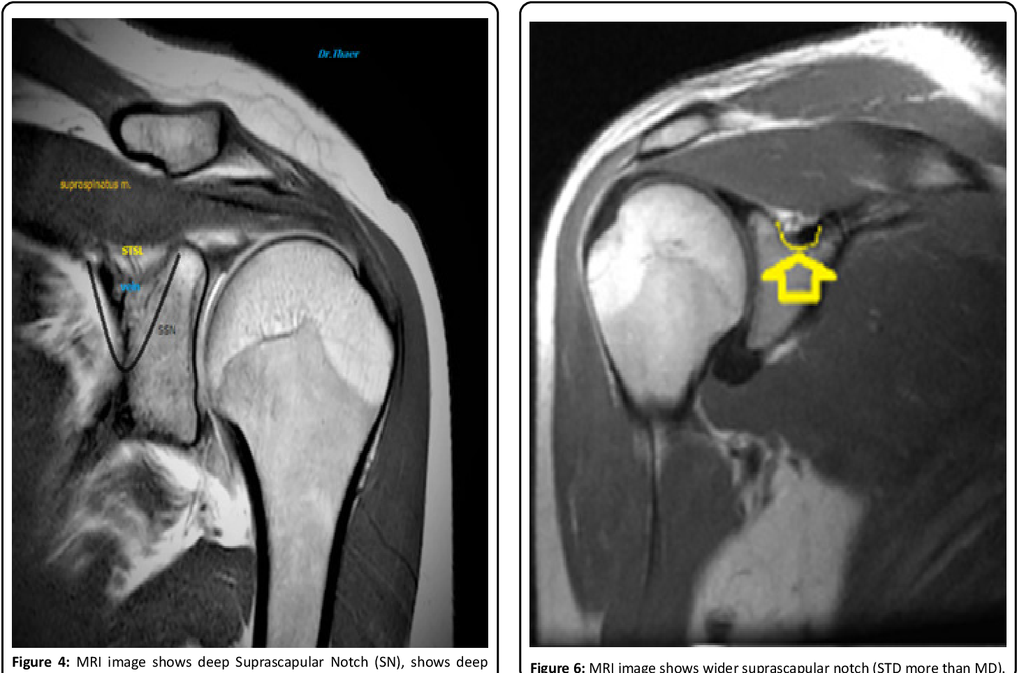 Figure 1 From Mri Evaluation Of Suprascapular Notch Morphometry And Its