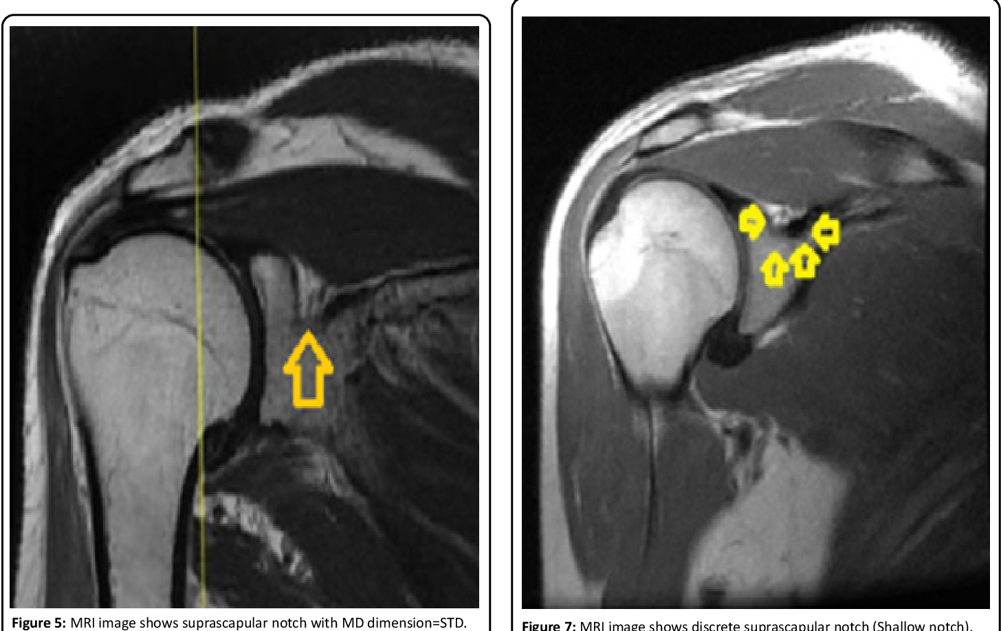 Suprascapular Nerve Entrapment Mri