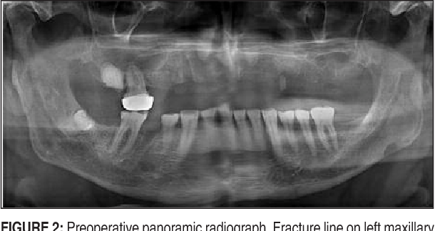 Maxillary Tuberosity Fracture