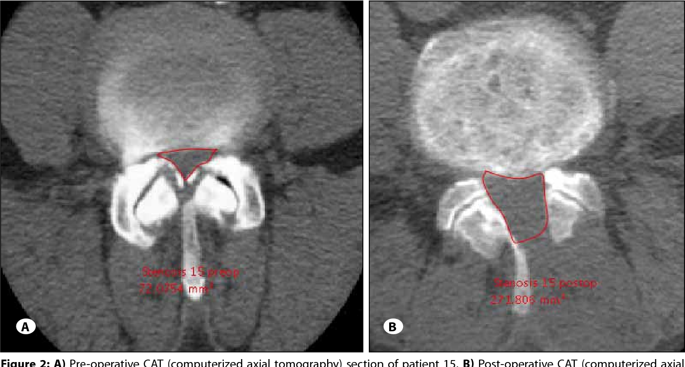 Figure 1 From A Comparison Of Bilateral Decompression Via Unilateral