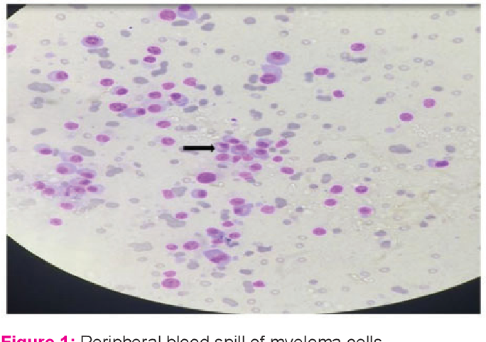 Figure 1 From Multiple Myeloma Presenting As Fatal Hyperviscosity