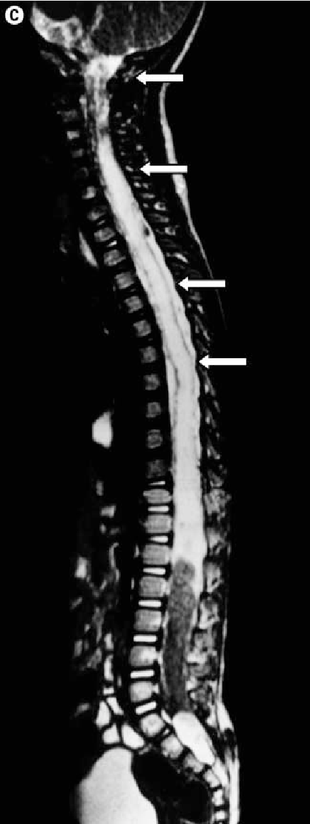 Figure 1 From Reversible Holocord Edema Associated With Intramedullary