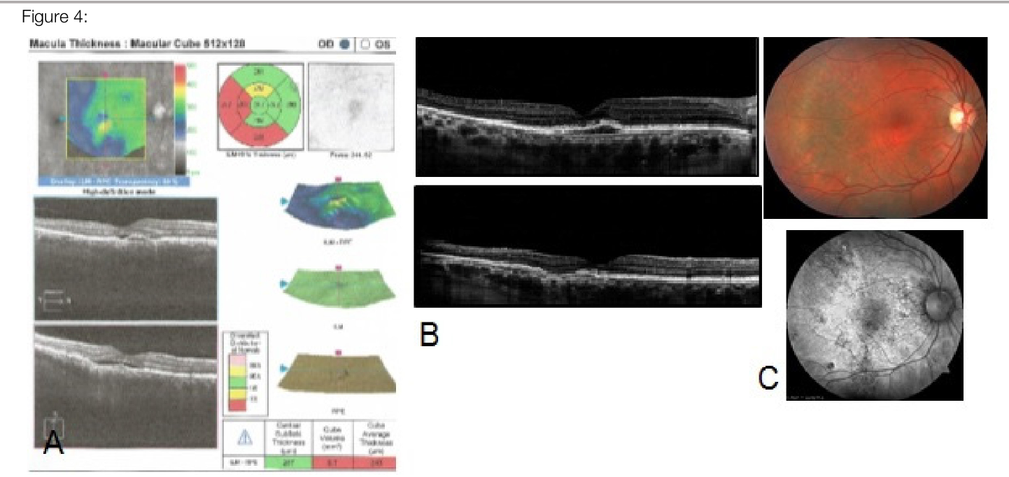 Update On Central Serous Chorioretinopathy Atualização Em