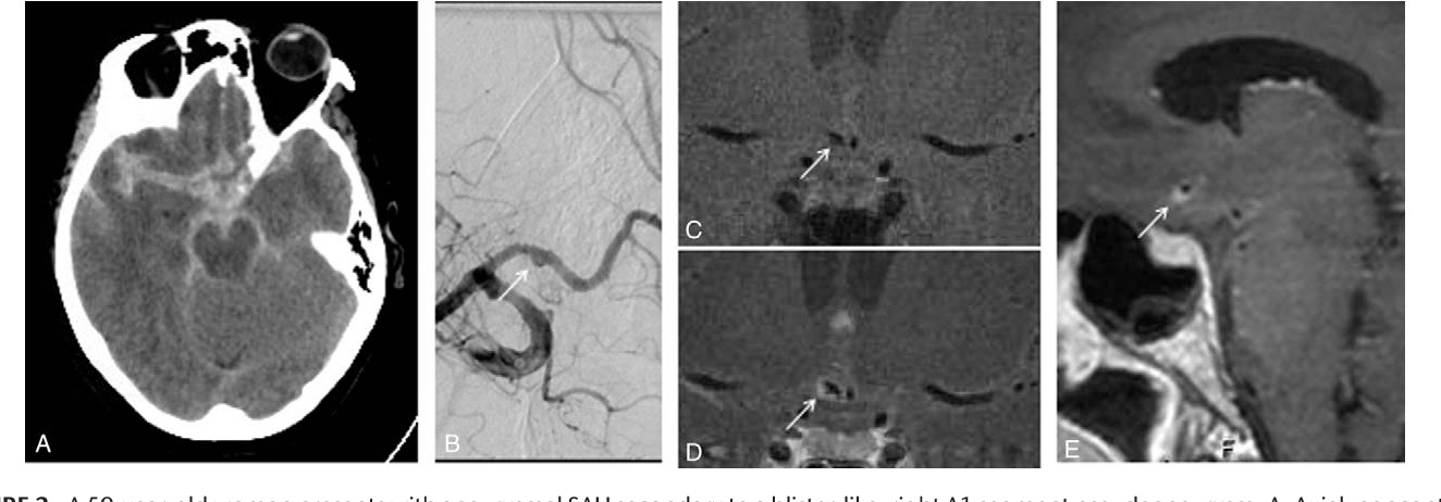 Figure 1 From High Resolution Vessel Wall Magnetic Resonance Imaging In